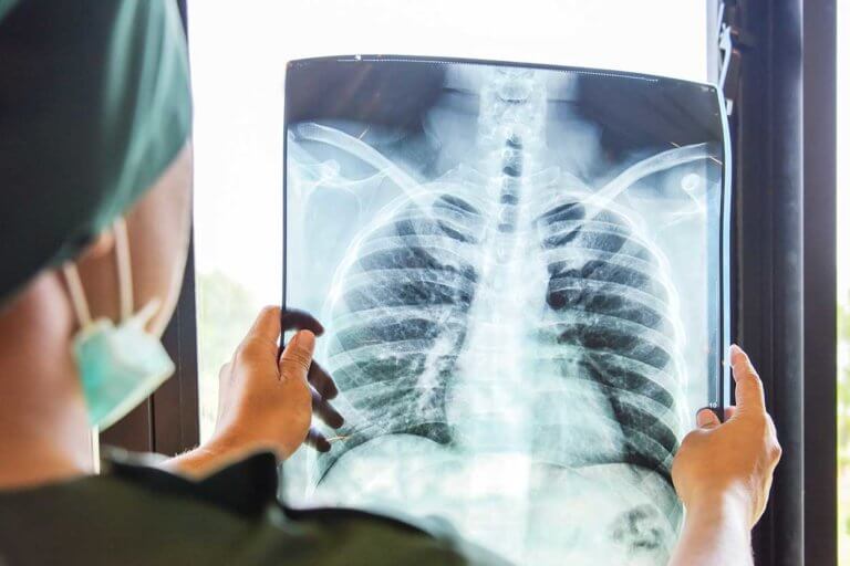 X-Ray Services for Positive TB (PPD) Chest Test Result