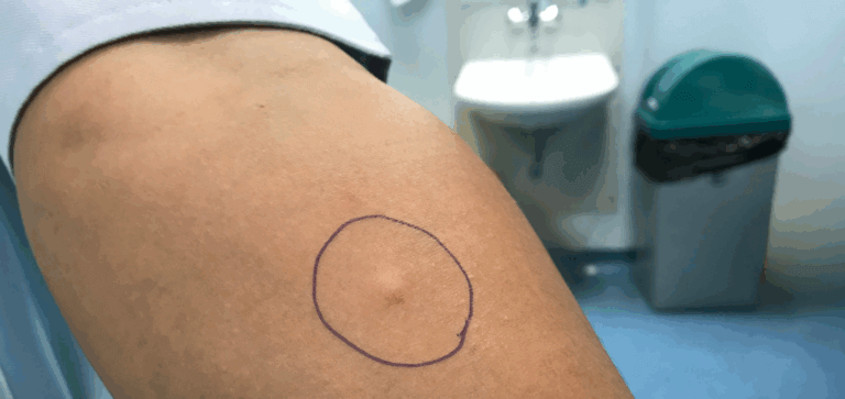 Benefits of QuantiFERON-TB Blood Test vs. PPD Skin Test